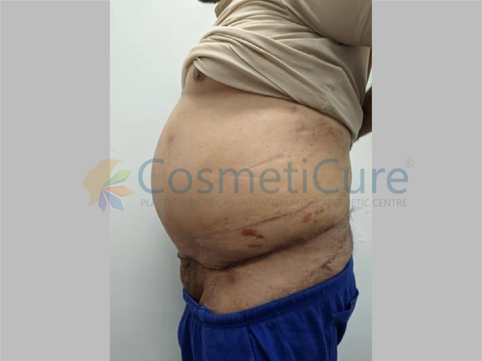 Tummy Tuck case 2